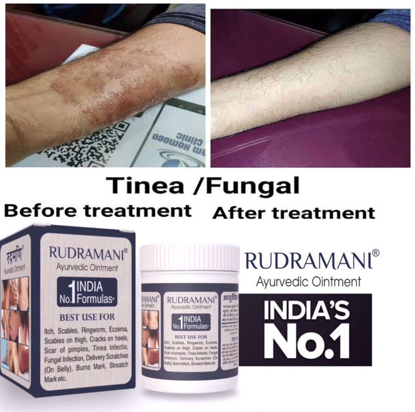 Ringworm Rash Treatment Cream How To Get Rid Of Ringworm: 7 Treatments